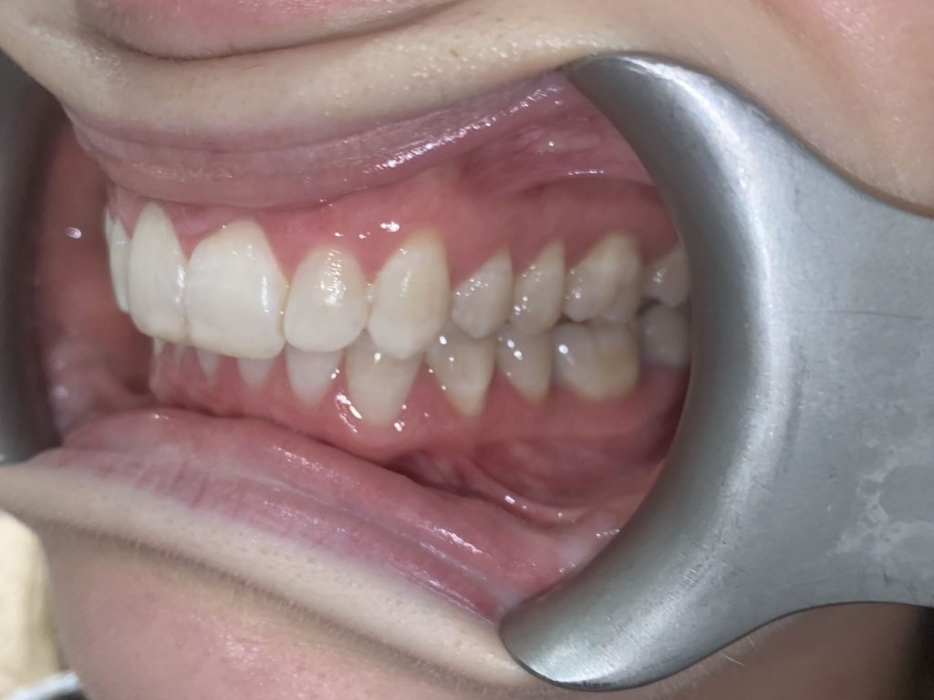 Invisalign Case Studies Before & After Examples - Milton Keynes