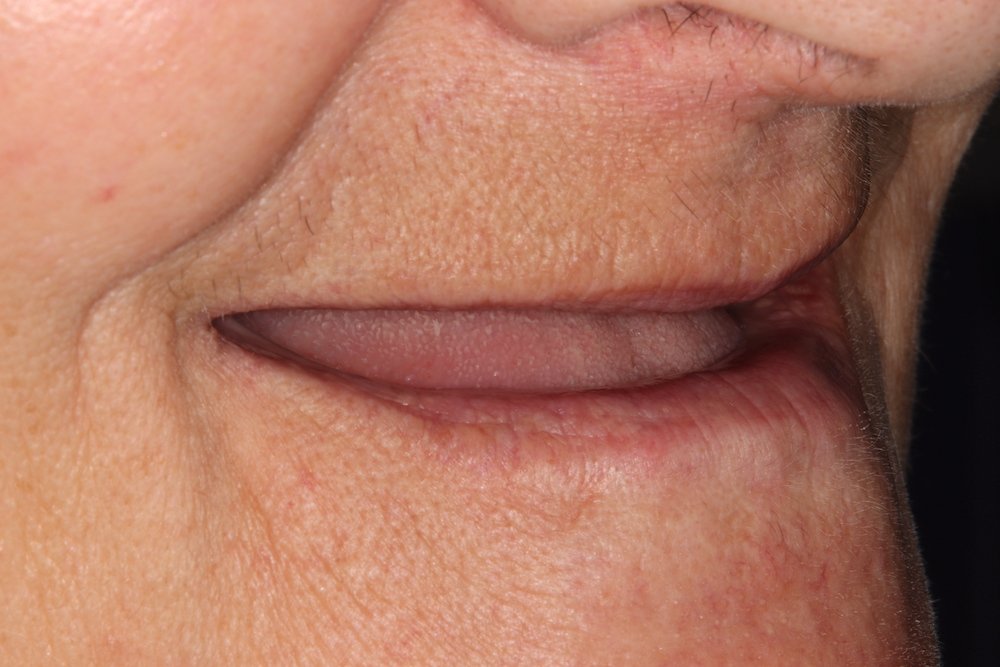 Dental Implants in Winslow and Buckingham - Special Terms